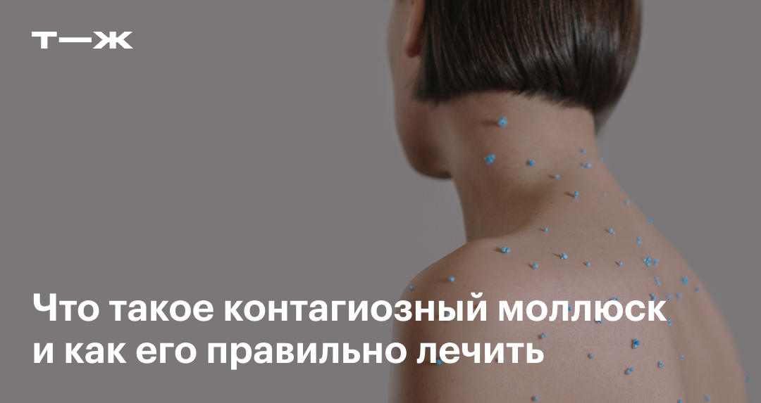 Контагиозный моллюск: что это, как выглядит и передается, симптомы, лечение