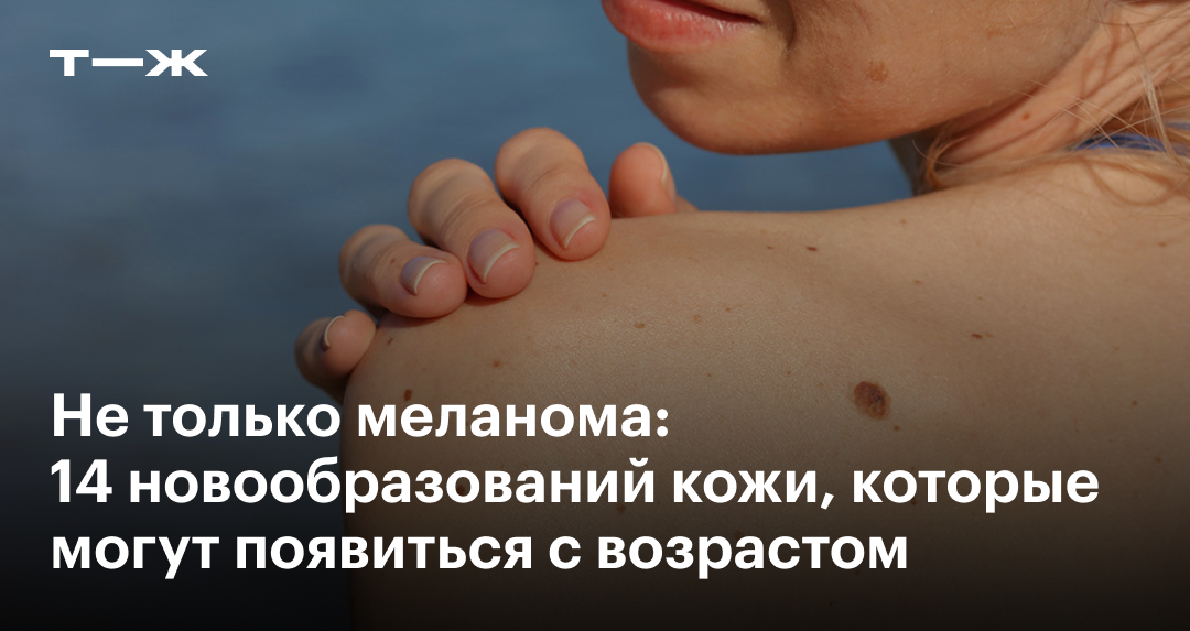 Новообразования на коже доброкачественные и злокачественные список